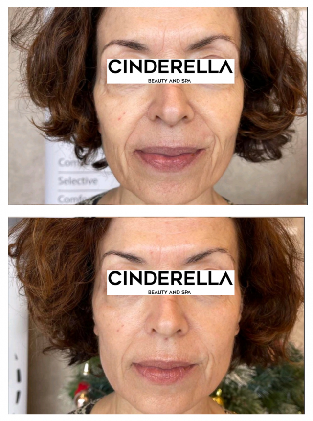Alma Accent Prime – Cinderella Beauty